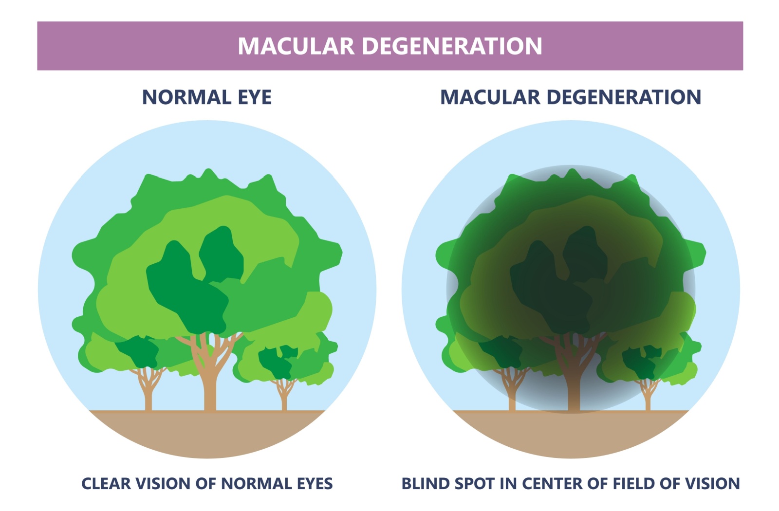 What Are The Warning Signs Of Macular Degeneration at Albert Glover blog